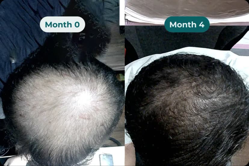 Finoxidil Capsules – Dual Oral Treatment for Hair Loss | GoRocky